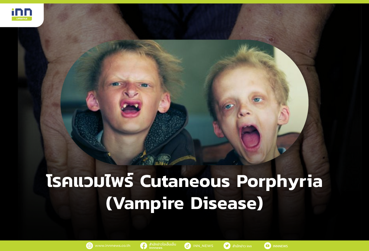 โรคแวมไพร์ Cutaneous Porphyria ( Vampire Disease)